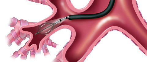 Advanced Bronchoscopy - Queensland Respiratory and Sleep